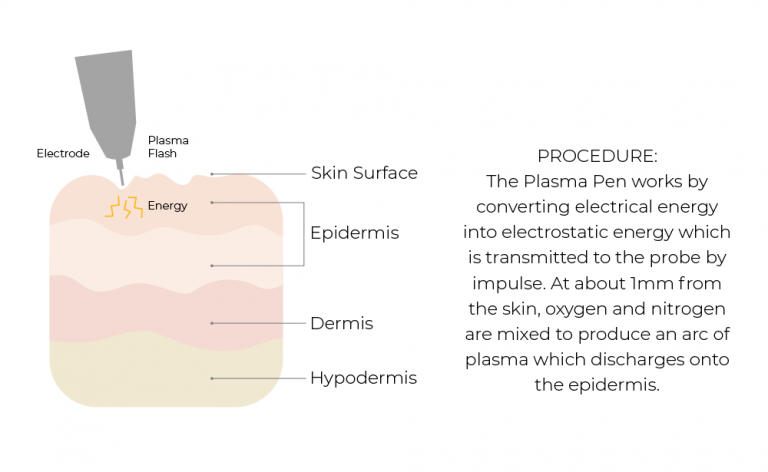 Plasma Pen - Botox Sisters Laura and Rebecca